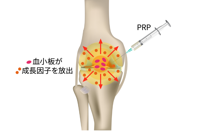 再生医療 | PRP-FD治療 | 綱島の駅チカ整形外科ならシン・整形外科 綱島【公式】